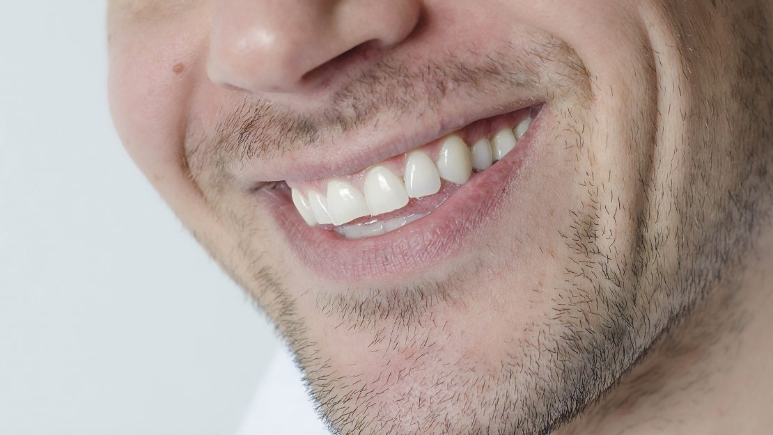 Fasete - savršeno rešenje za vaš savršen osmeh!