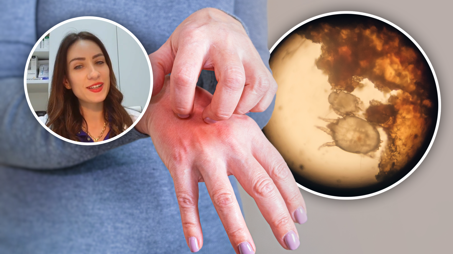 Šuga nije iskorenjena bolest, a simptomi mogu da se jave i tek posle 6 ...